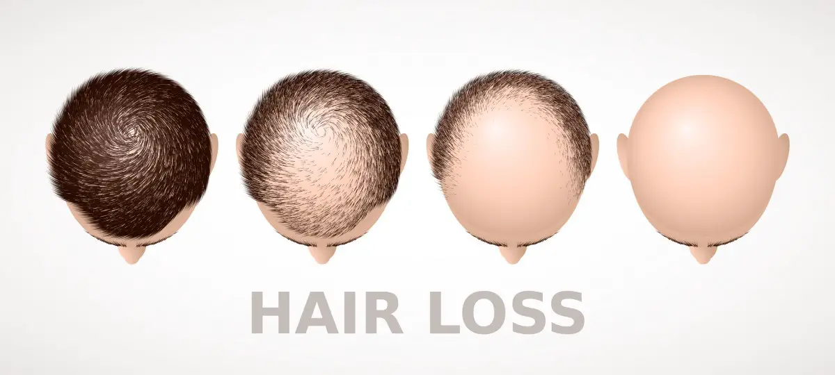 Early Signs Of Balding And How To Prevent It